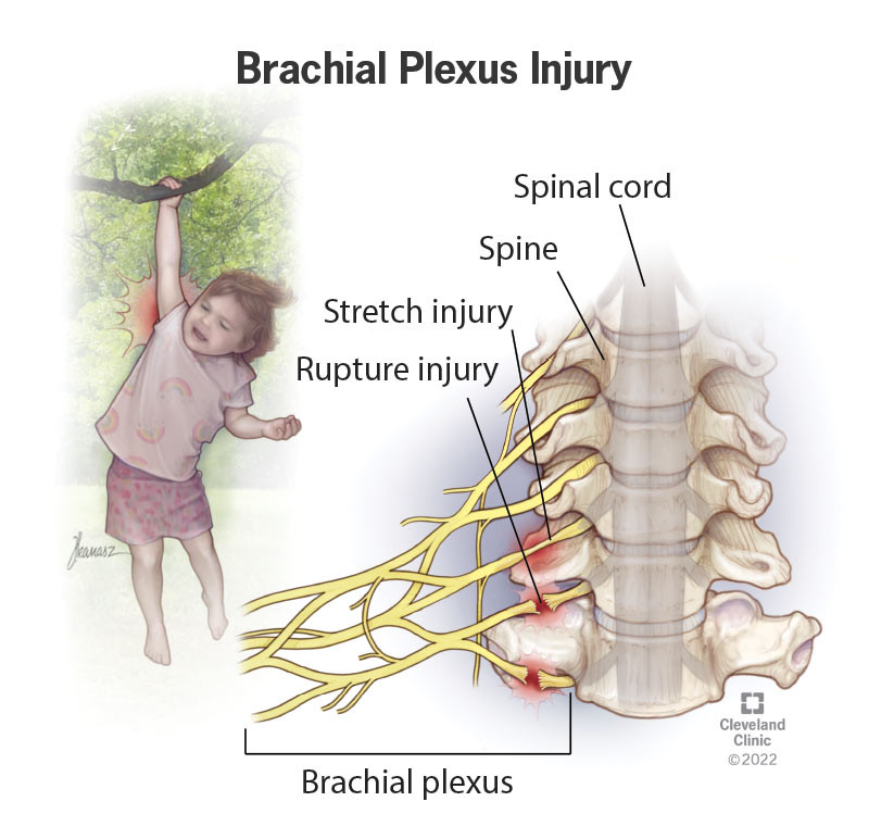 Brachial Plexus Injury | Maximum Performance Sports & Physio Therapy