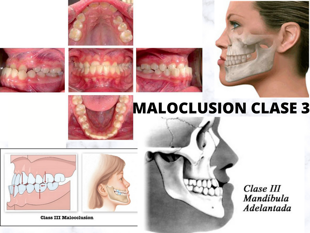 MALOCLUSION CLASE 3