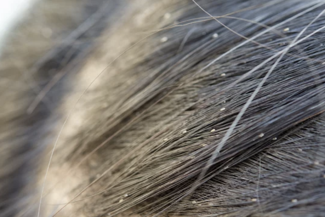 Back to school = back to lice? TIPS TO PREVENT LICE BEFORE THEY INFEST!