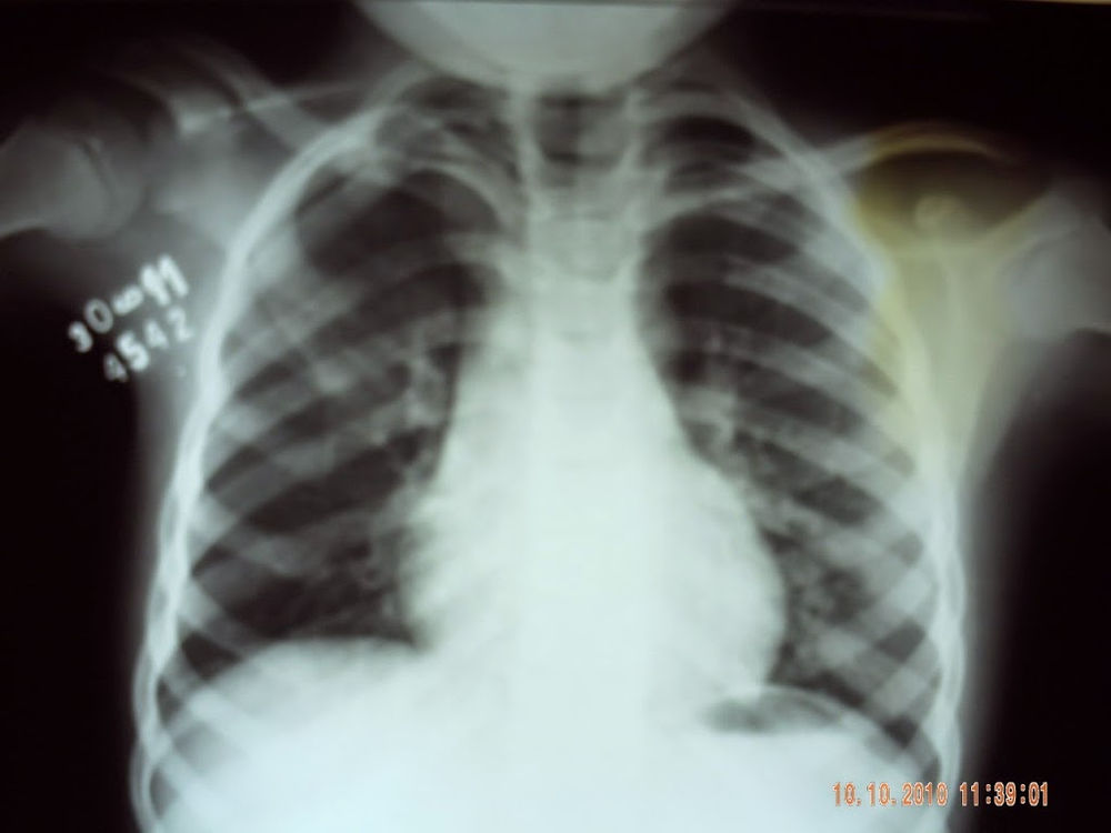 A‌ ‌escápula‌ ‌alta‌ ‌congênita:‌ ‌o‌ ‌que‌ ‌fazer?‌