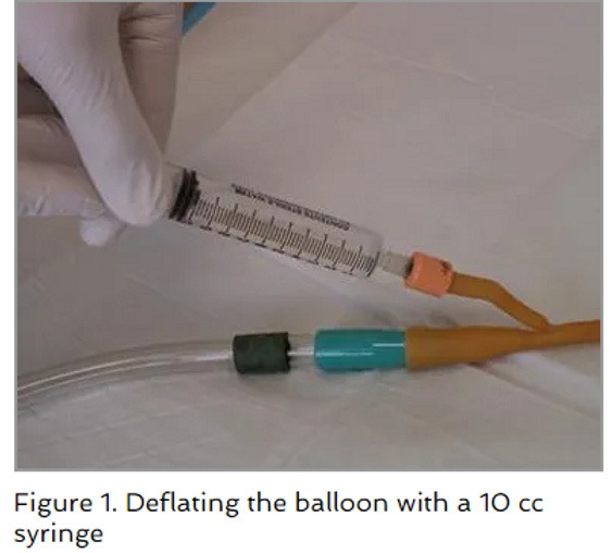 Technique to remove a foley cathether