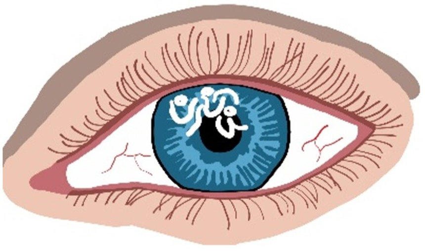 Epithelial Basement Membrane Dystrophy