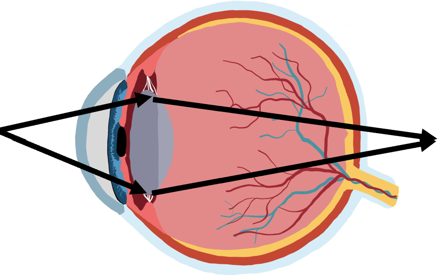 Hyperopia (farsightedness)