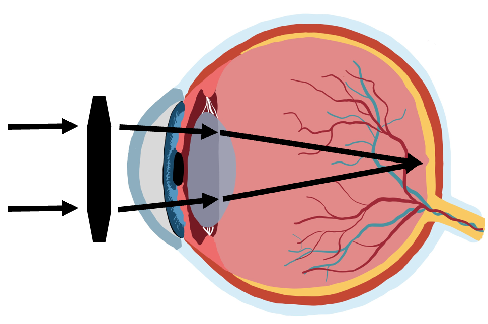 Hyperopia (farsightedness)