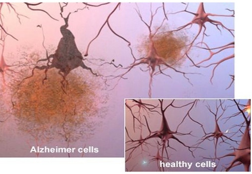 What Are Plaques and Tangles? | Alzheimer's Organization