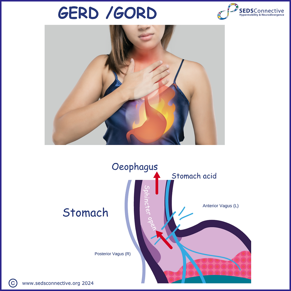 Oh my GERD or GORD!