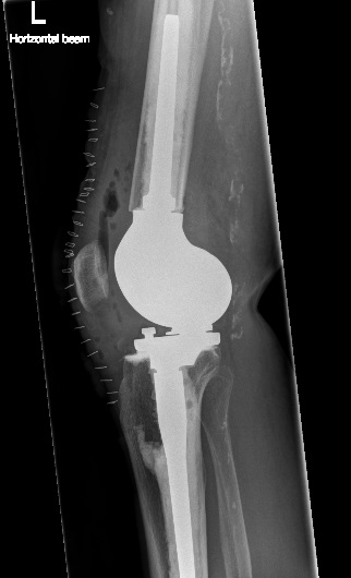 Knee Surgery | CQ Orthopaedics
