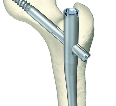 Hip & Knee Replacement, Foot & Ankle, Trauma | CQ Orthopaedics