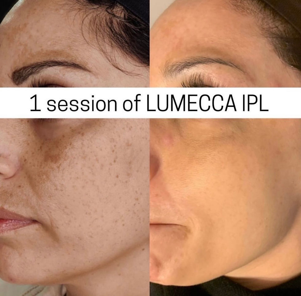 Illuminate Your Skin: Embrace IPL Lumecca for a Radiant Winter Glow