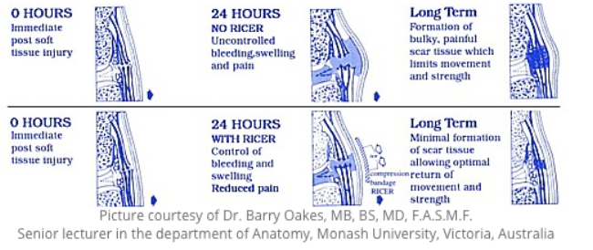 Understanding scar tissue