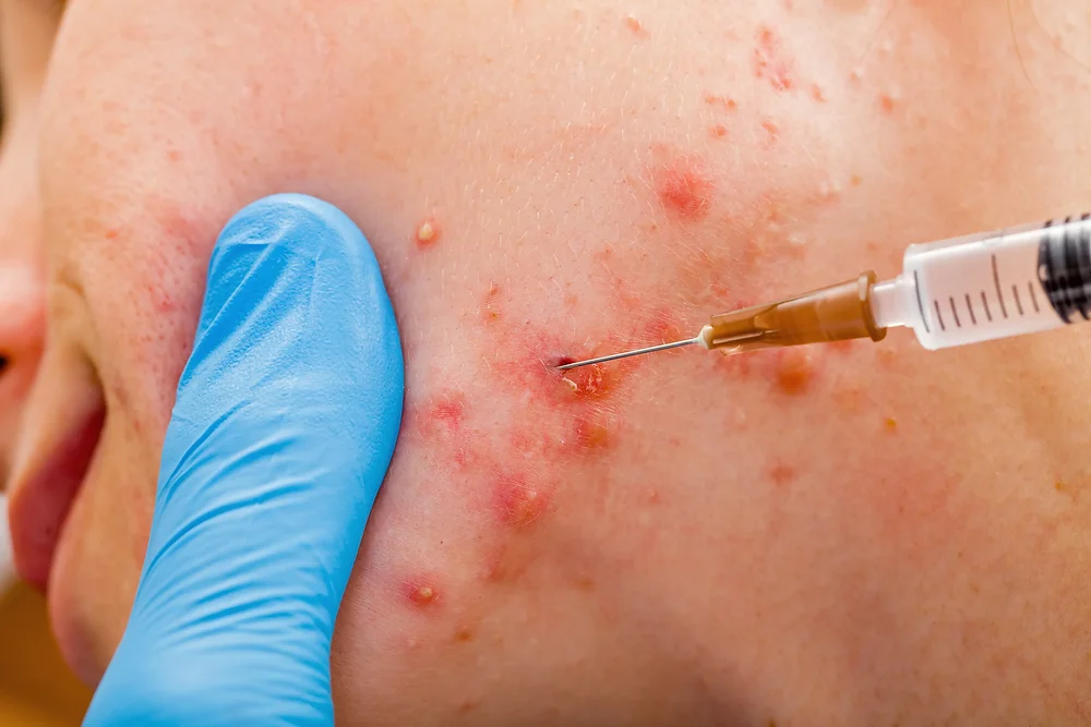 Cortisone Acne Steroid Injections in Singapore: Benefits, Side Effects ...