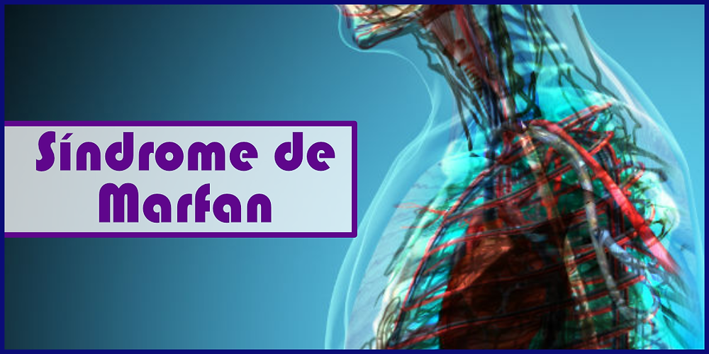 Síndrome de Marfan