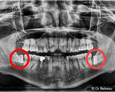 Wisdom Teeth Removal Phoenix & Scottsdale | Dr Bebeau