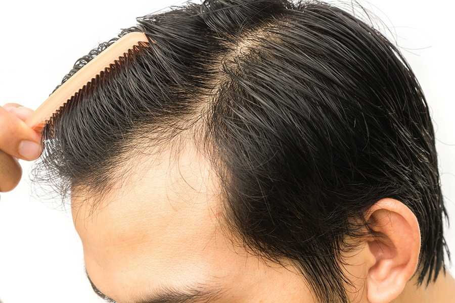 Can I wear a Hat to cover the Dark Red Spots after a Hair Transplant ...