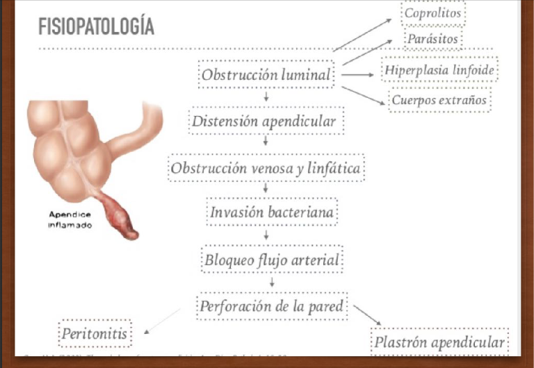 Apendicitis Aguda por el Dr. Lindsay