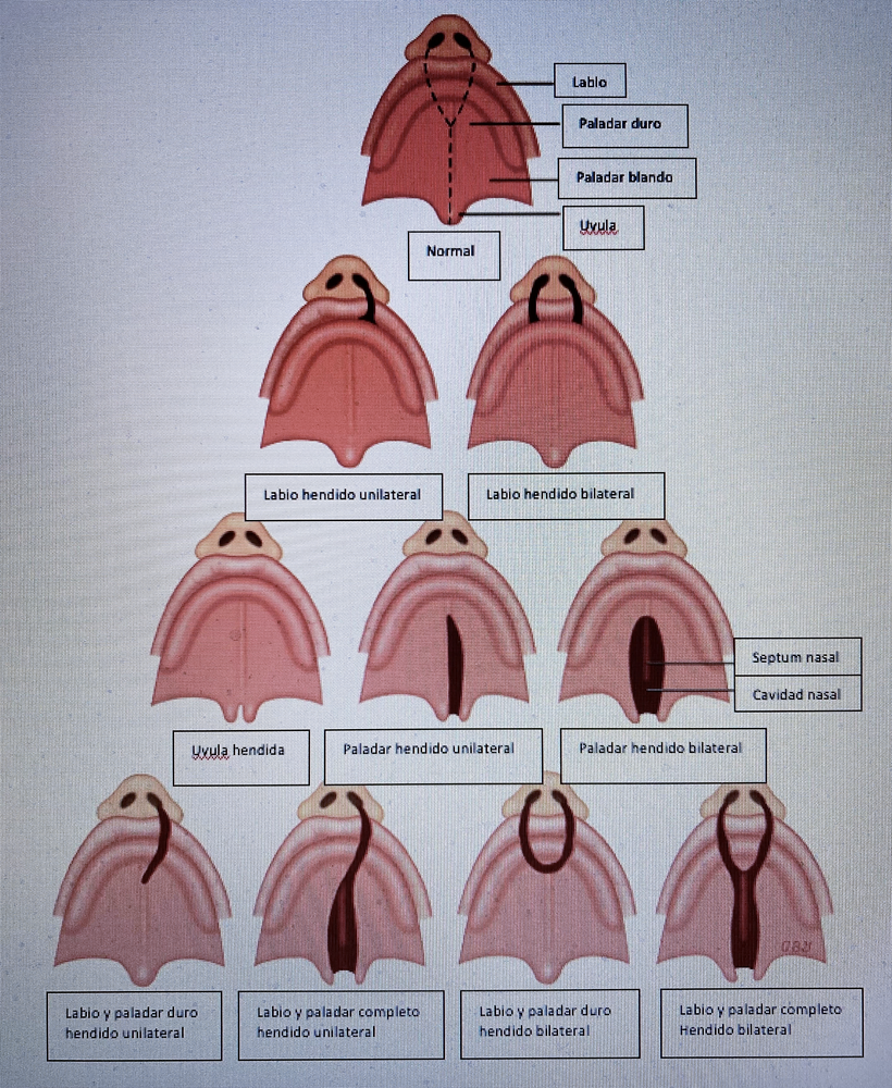 Labio y paladar hendido (LPH)