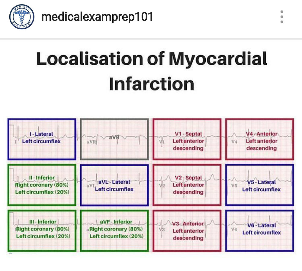 Location of a Myocardial Infarction