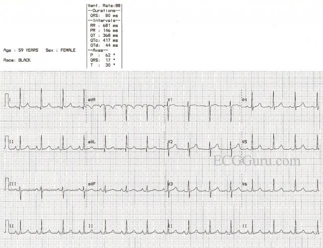 Normal 12-Lead ECG