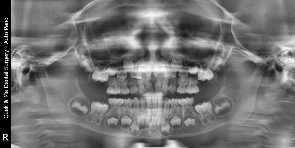 Is Dental X-ray needed for kids?