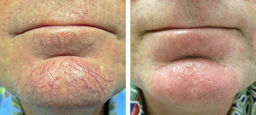 IPL: Chin & Neck | Dutch Hollow Medical