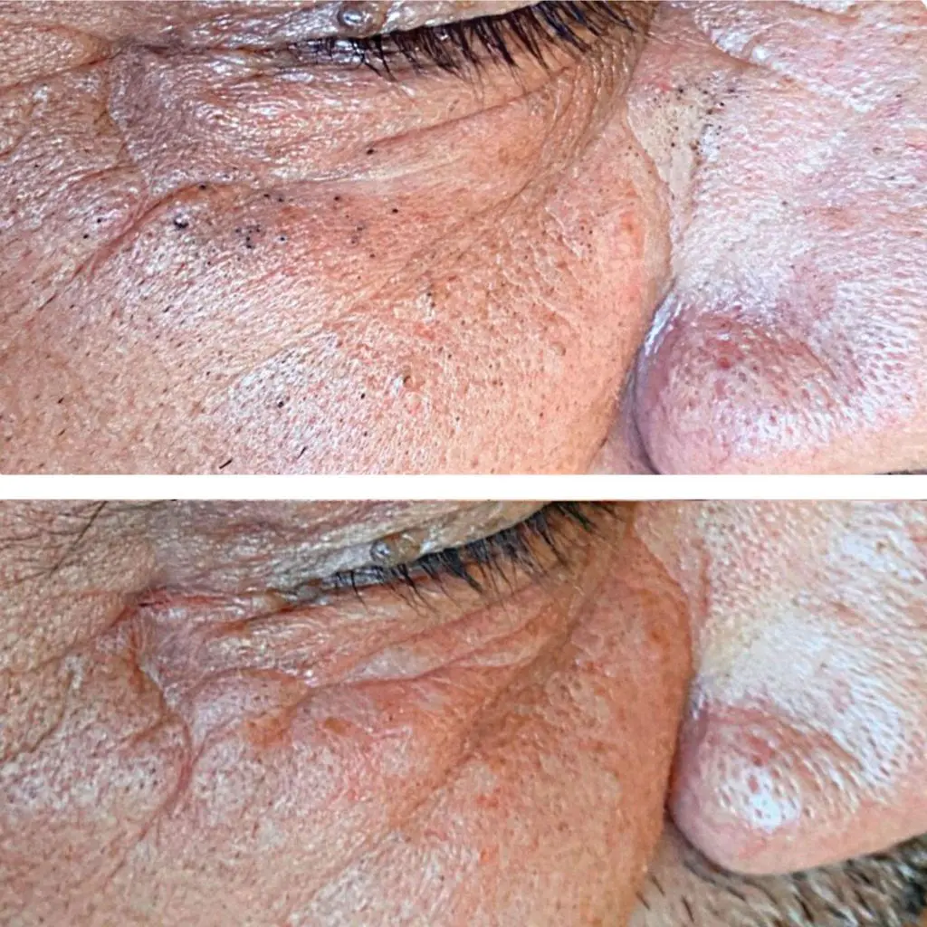 Extractions | Dutch Hollow Medical