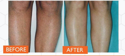 IPL: Half legs | Dutch Hollow Medical
