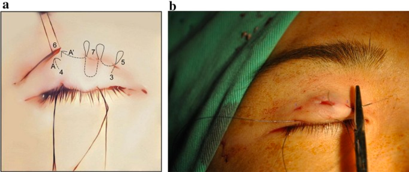 Exploring the Buried Double Twisted Suture (BDTS) Technique in ...