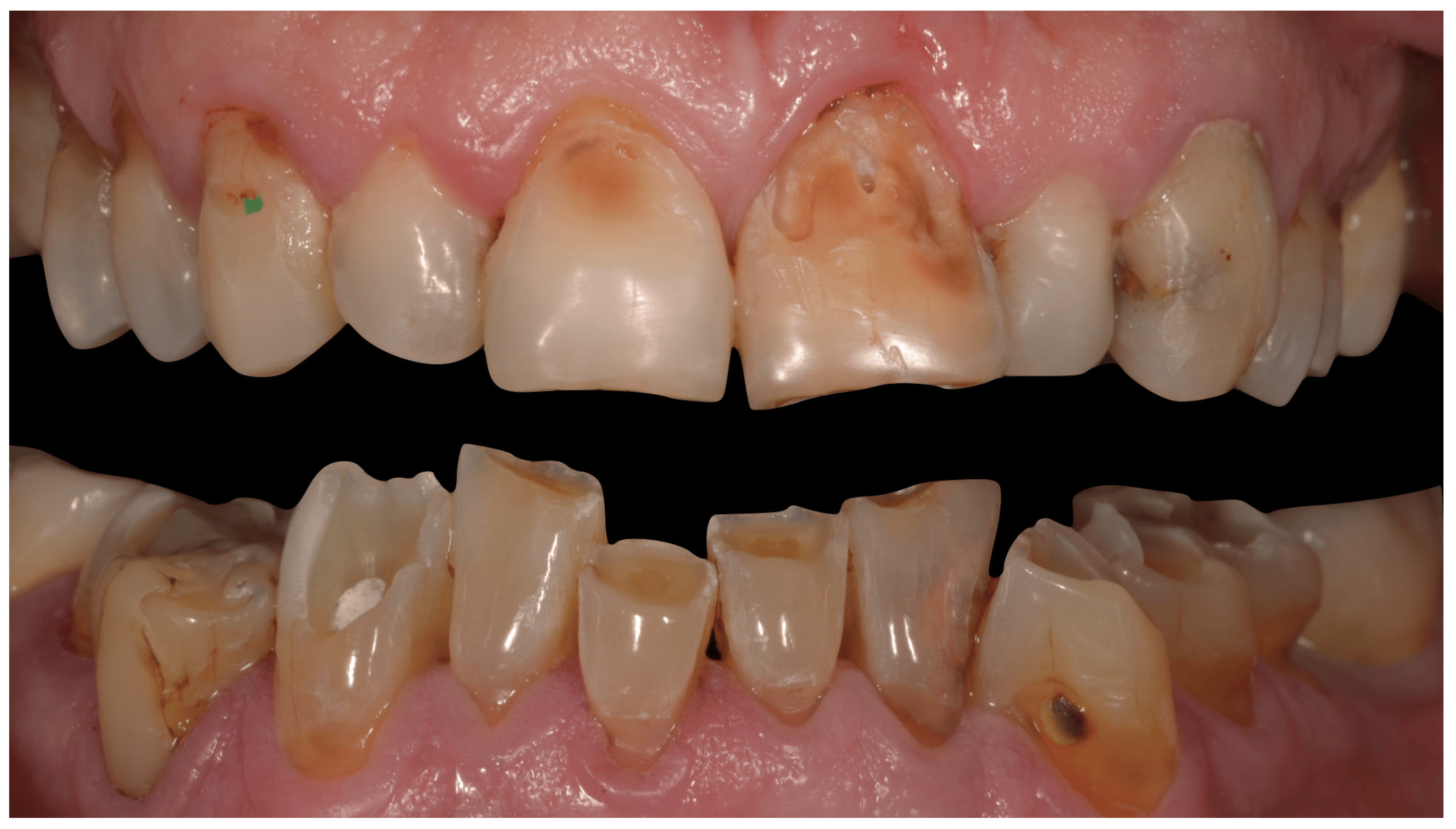 Celiac Disease & Brown Spots on Teeth - Is there a Link?