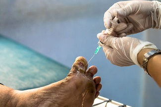 Assessing Wound Tissue and Drainage Types: Slough Versus Purulence