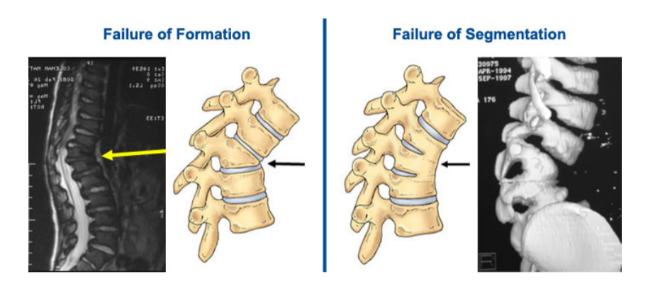 Thoracic Hyperkyphosis