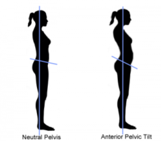 Lumbar Hyperlordosis