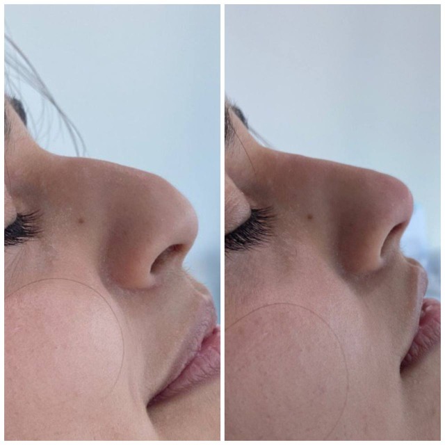 5-Minute Nose Job – Non-Surgical Rhinoplasty in Dubai