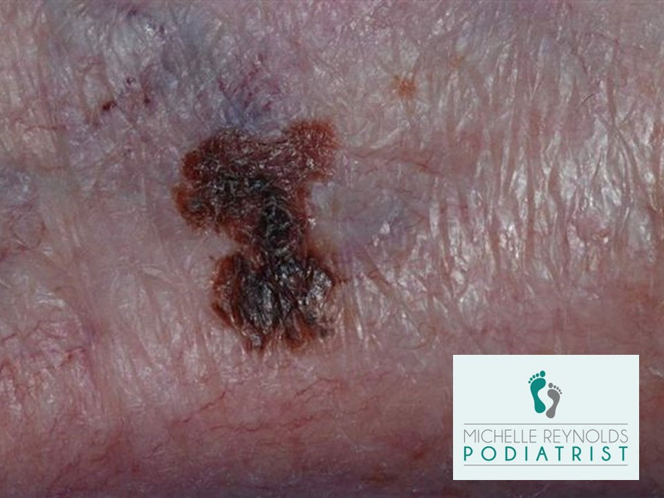 Can you get skin cancer on your foot?