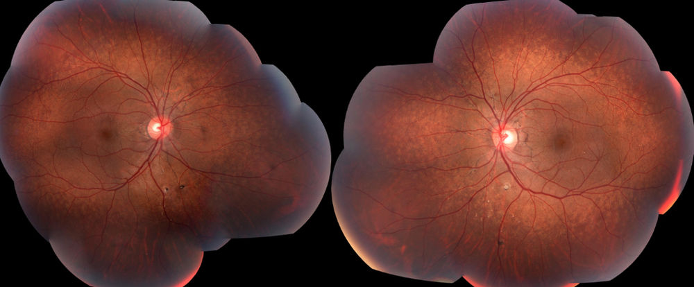 O que são estrias angioides?