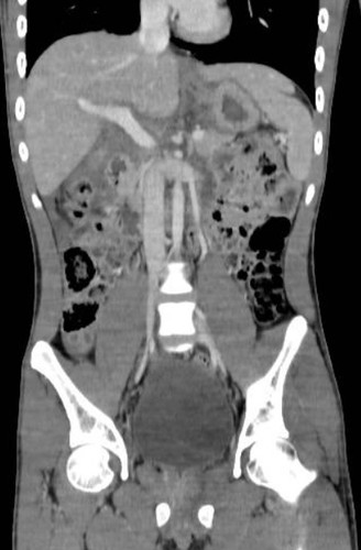 TAC de abdomen total simple y contrastado | Radiología HU