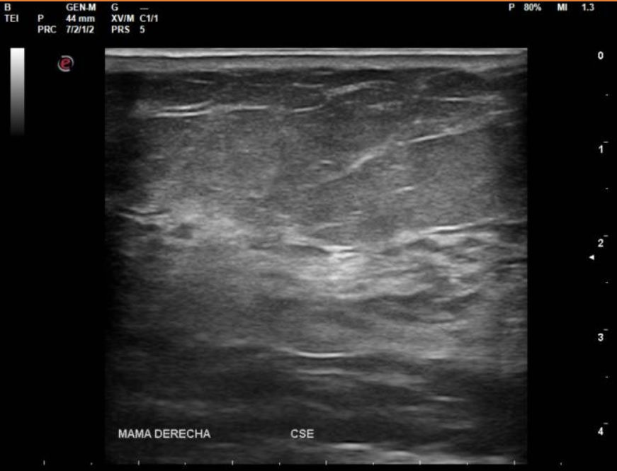 Ecografía de mama | Radiología HU