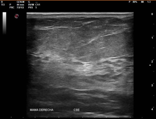 Ecografía de mama | Radiología HU