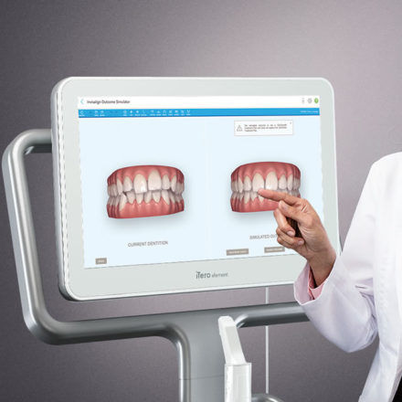 Advantages of the ITero digital intraoral scanner?