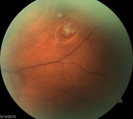 Décollement du vitré postérieur, dégénérescence palissadique et ...