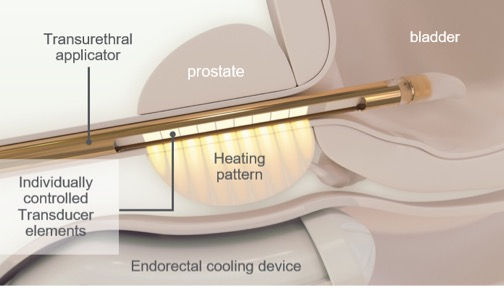 TULSA Treatment for Prostate Cancer: A Practical Guide