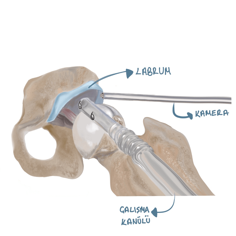 Hip Labral Tear: Causes, Symptoms, and Treatment