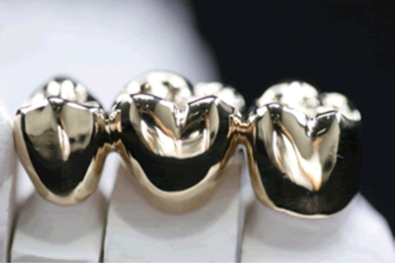 Exploring the Benefits of Full Alloy Dental Restorations
