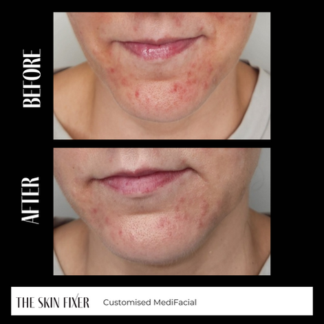 The Skin Fixer | Skin Treatments | Facials | Skin Correction | Melbourne