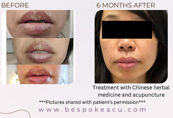 exfoliative cheilitis success stories