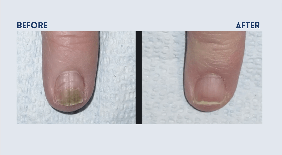 Laser Toenail Fungus Removal | Euro Laser Spa