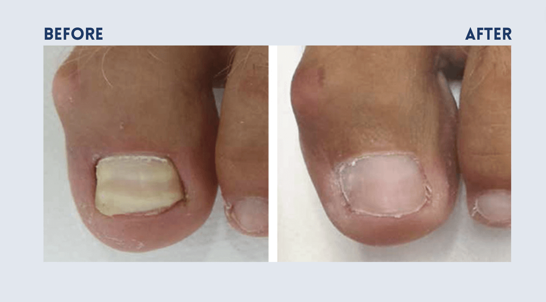 Laser Toenail Fungus Removal | Euro Laser Spa