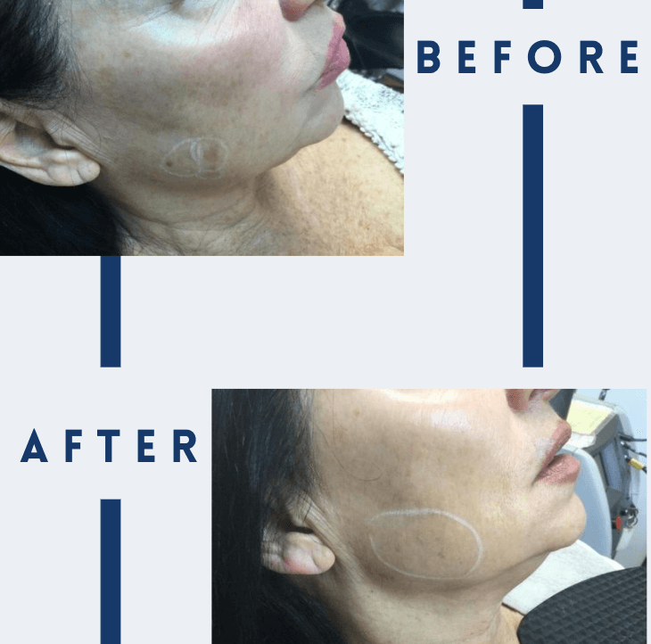 Laser Brown Sun/Age Spot Removal | Euro Laser Spa