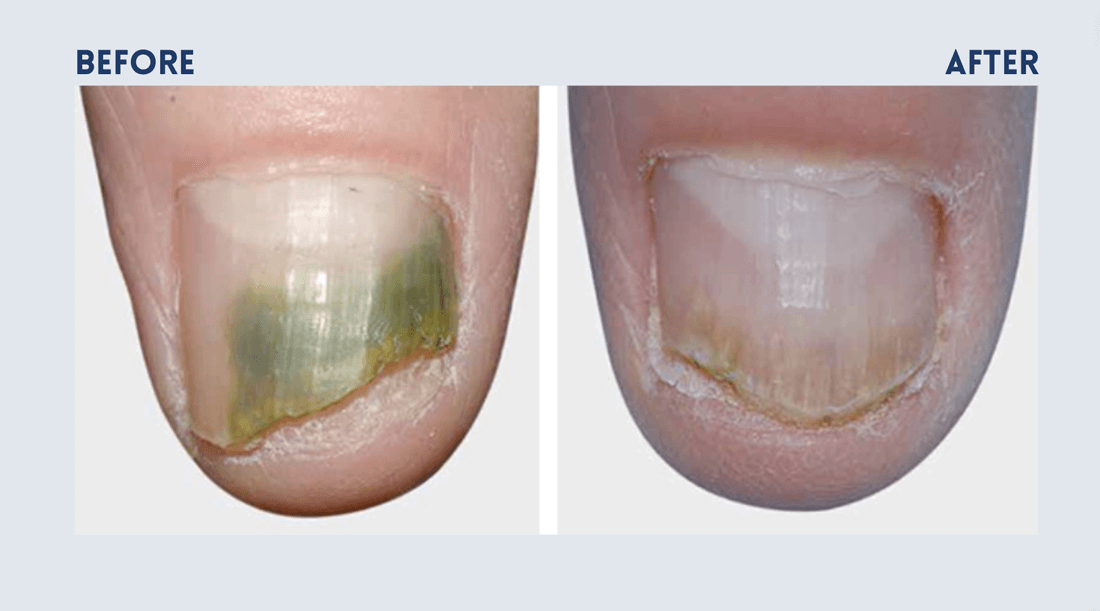 Laser Toenail Fungus Removal | Euro Laser Spa