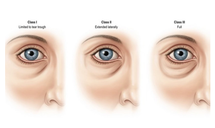 What is the tear trough?