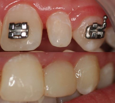 Composite | McDonaldMiddleton | How to fill spaces between teeth